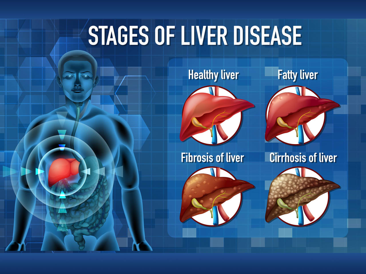 Gejala Penyakit Liver atau Perlemakan Hati (Fatty Liver Disease) | Panomnom